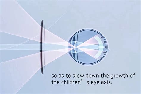News Product Introduction Defocus Incorporated Multiple Segments Lenses