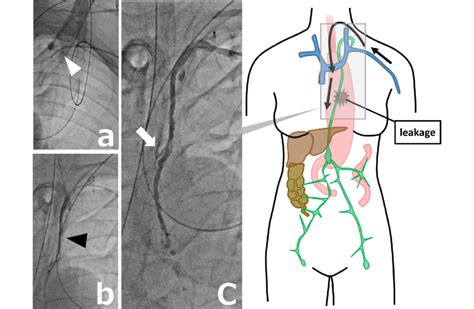 Transvenous Retrograde Thoracic Duct Embolization A B Microcatheter