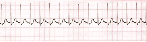 Ekg Practice Drill