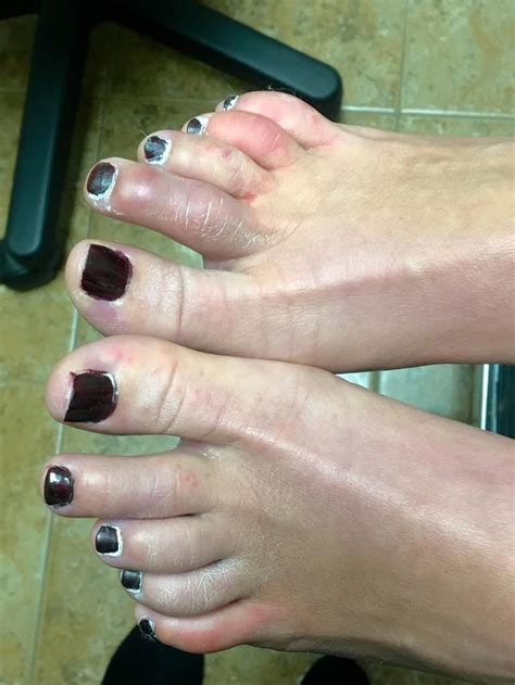 Pretty Sure I Just Diagnosed Myself R Erythromelalgia