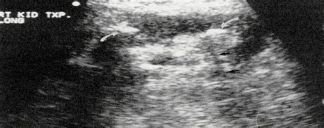 Emphysematous Cystitis And Pyelitis In A Diabetic Renal Tran Transplantation