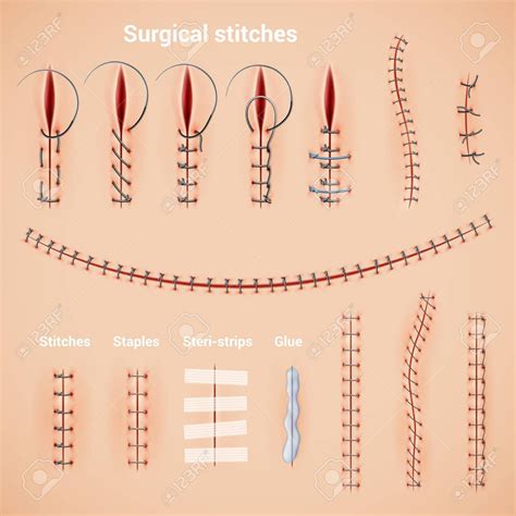 Surgical Suture Stitches Realistic Set Of Stitching Methods And Shapes With Staples Glue And