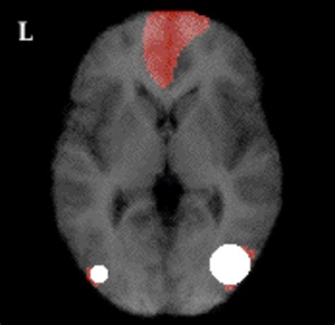 Within Modality Auditory Priming Statistical Parametric Maps Spm Download Scientific Diagram