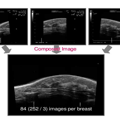 The 3d Whole Breast Volumetric Data Is Constructed By Stitching Download Scientific Diagram