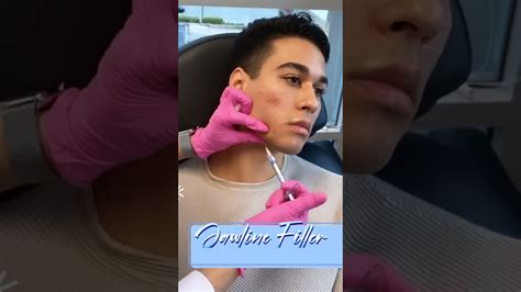 Injectable Filler In Dublin Suretherapy Top Laser Beauty Healing