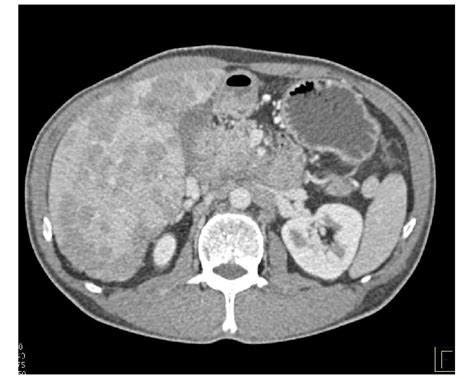 Ct Scan Of Abdomen And Pelvis Showing Primary Pancreatic Malignancy