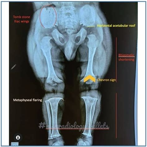 Achondroplasia X Ray Findings