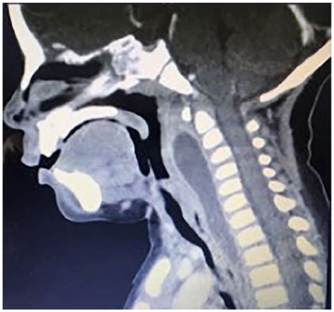 Retropharyngeal Abscess With Mediastinal Extension A Case Series And
