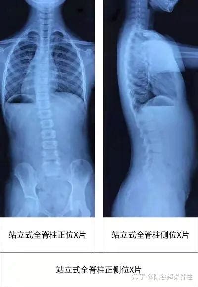 脊柱侧弯为什么要拍正侧位全脊柱X光片 知乎
