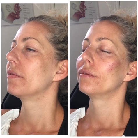 Cheek Augmentation Cotswold County Aesthetics