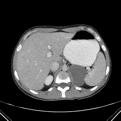 Gastric Duplication Cyst Pacs