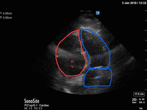 Right Ventricular Dilation In Patient With Submassive Pulmonary Embolism Jetem
