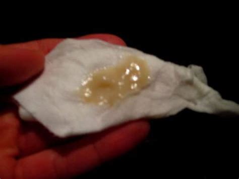 Huge Loogie I Spit Out Yesterday R Pics