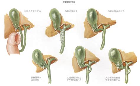 Lc 术中胆总管损伤，这 4 种技术能救急 丁香园