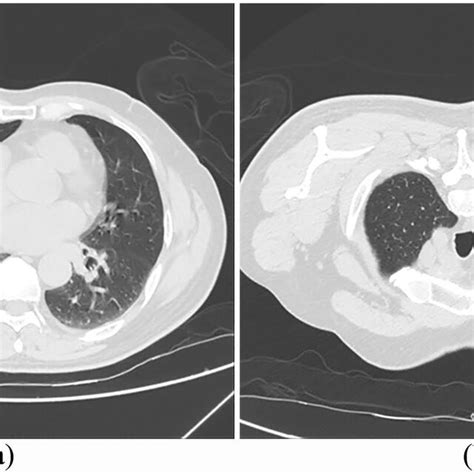 Ct Guided Coil Localization For Bilateral Mlns Ct Demonstrates Two Download Scientific Diagram