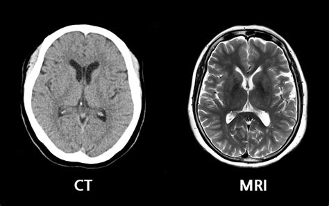 뇌 Ct와 Mri의 차이점과 Ct 검사를 해야 하는 경우 100 Age Health