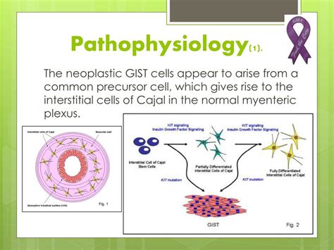 Ppt Gists Gastrointestinal Stromal Tumor Powerpoint Presentation Free Download Id 2046838