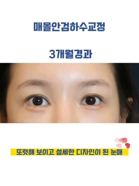 마법의 매몰 두줄따기 더스완성형외과 Youtube