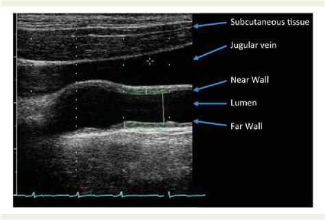 Carotid Intima Media Thickness Semantic Scholar