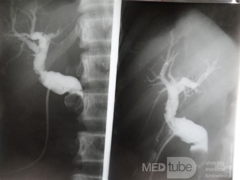 T Tube Cholangiography Show Missed Stone In The Common Bile Duct • Picture •
