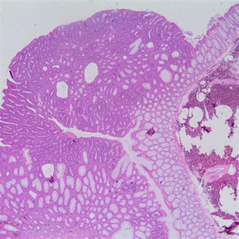Gross Appearance Of The Large Bowel In Sessile Serrated Lesionpolyp