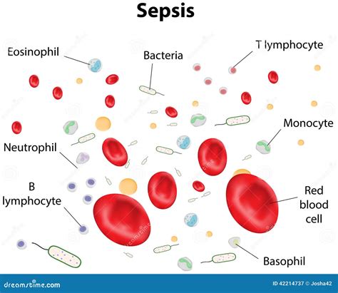 Sepsis Stock Vector Illustration Of White Infection 42214737
