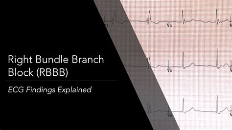 Right Bundle Branch Block Rbbb Ecg Youtube