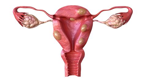 Fibroid Quiz Quiznow