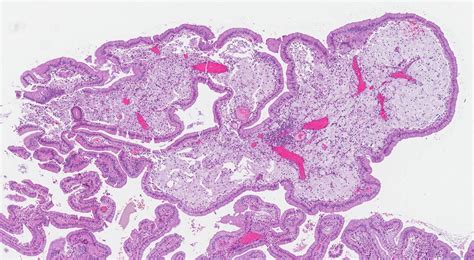 Chronic Cholecystitis Ottawa Atlas Of Pathology