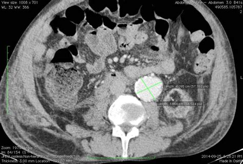 Pre Operative Ct Scan Download Scientific Diagram