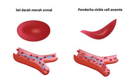 Apa Perbedaan Bentuk Sel Darah Merah Normal Dng Be