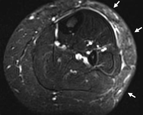 Mr Imaging Of Soft Tissue Vascular Malformations Diagnosis