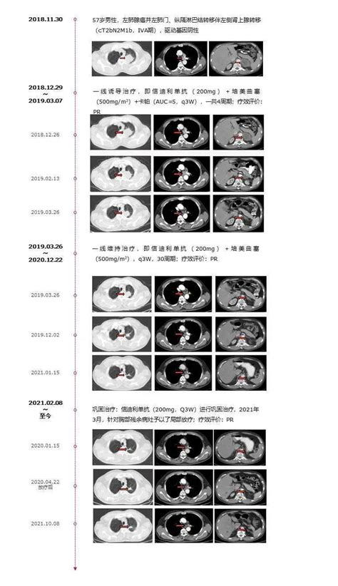 Orient 11研究奠定免疫联合化疗治疗驱动基因阴性非鳞状nsclc地位患者迪利王哲海