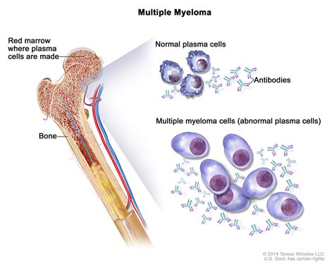 Multiple Myeloma Stages And How They Differ
