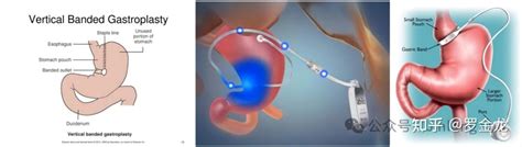 减重代谢手术的发展及历史演进 知乎