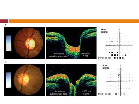 Oct In Ophthalmology Pptx