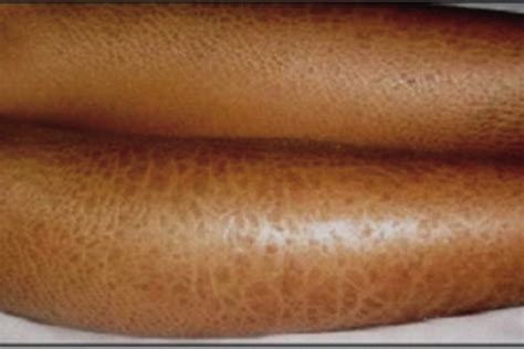 Berita Ichthyosis Vulgaris Terbaru Hari Ini Grid Id