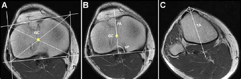Figure 1 From Tibial Tuberosity Rotation In Patients With Patellar