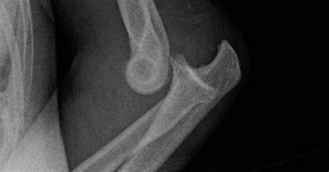 Pic Dana White Shares Horrific X Ray After Fighter Breaks Elbow At Ufc Vegas 77