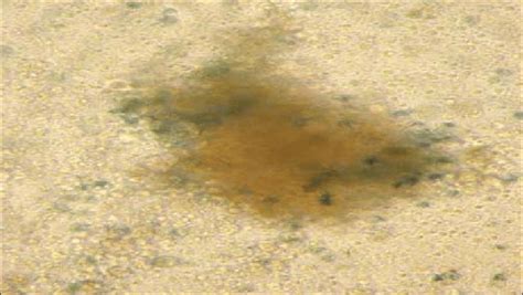 Erythroid Colonies Appearing Blue With Benzidine Staining Download