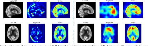 Figure 1 From Attention Based 3d Cnn With Multi Layer Features For Alzheimers Disease Diagnosis