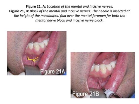 Mandibular Nerve Block Pptx