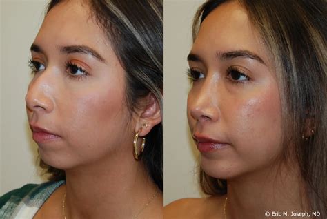 Eric M Joseph Md Chin Implant Before And After Photos