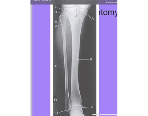 Final Exam Tibia Fib Quiz
