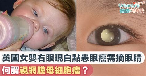 【眼癌】女嬰右眼出現白點患眼癌需摘眼睛 何謂視網膜母細胞瘤？ Urbanlife 健康新態度