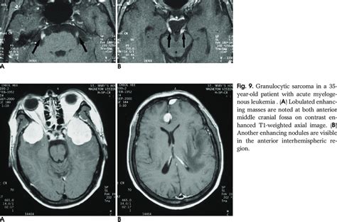 Cranial Nerves Involvement In A 32 Year Old Male Patient With Acute
