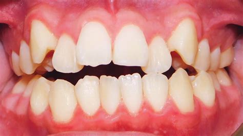 Class Ii Subdivision Left Malocclusion Anterior Open Bite Skeletal
