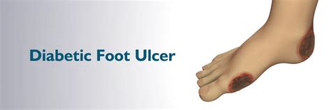 Diabetic Foot Ulcers Causes Symptoms Treatment And Prevention