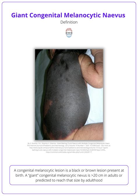 Congenital Nevus