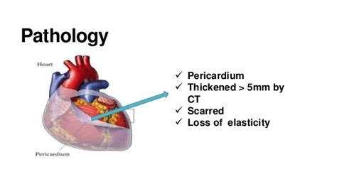 Constrictive Pericarditis